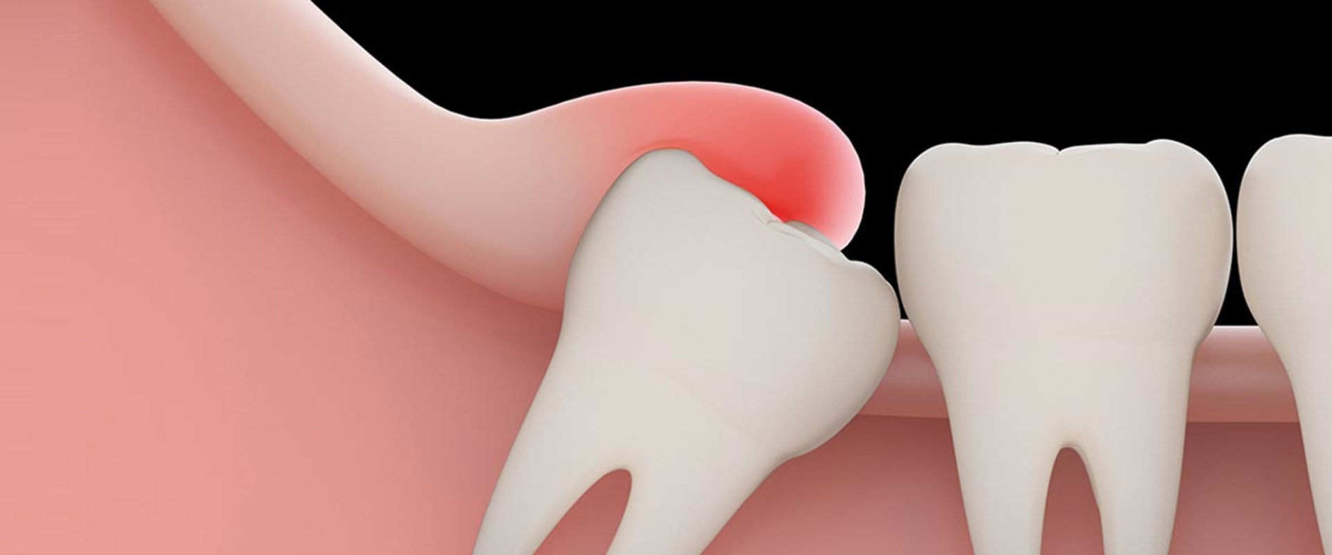 Why Do Emergency Tooth Extraction Procedures Need Dental X-Rays In London