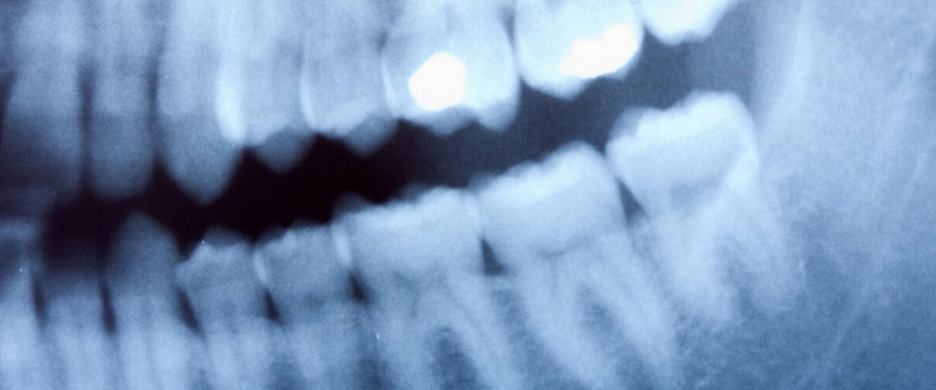 Who discovered dental x rays?
