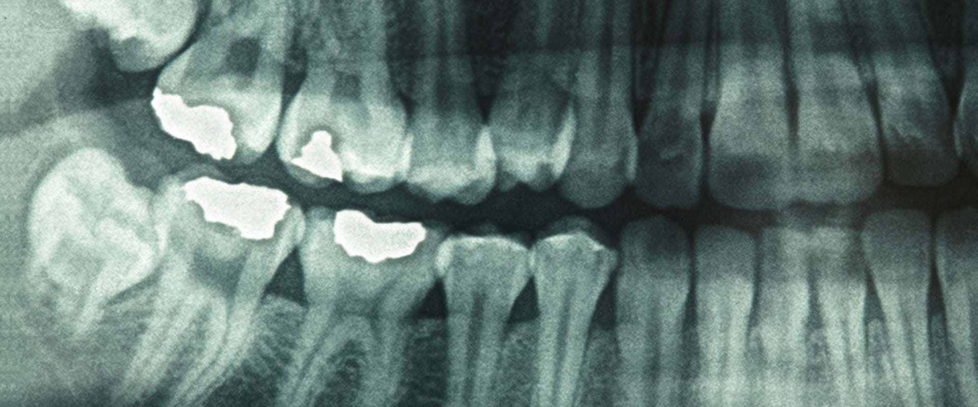What is the side effect of dental x-ray?